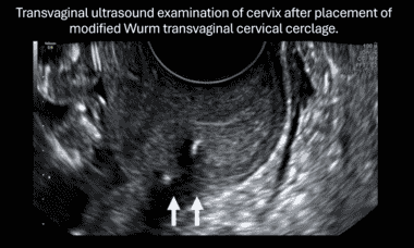 UOG videoclip: Transvaginal cervical cerclage: double monofilament ...