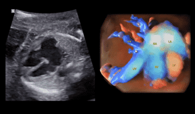 UOG videoclip: Four-dimensional imaging of umbilical-vein-to-right ...