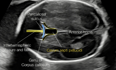 ISUOG advanced neurosonography course: the dark side of the brain and ...