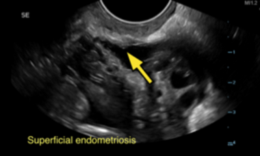 VISUOG's chapter on Superficial Endometriosis is open access this July.