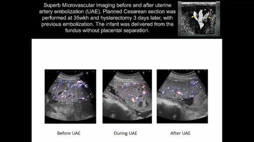 Uog Video Clip Diagnosis Of Placenta Accreta Spectrum Using Ultra‐high
