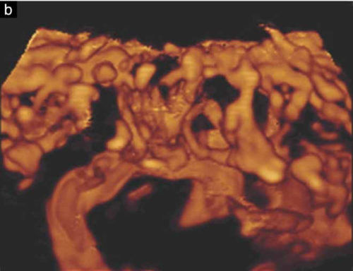 Placental insufficiency: from causes to consequences, from prediction ...