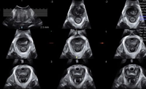 Urogynecology and pelvic floor ultrasound