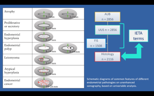 UOG video clip: Typical ultrasound features of various endometrial ...