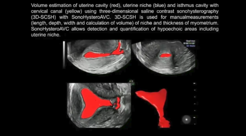 Evaluation of uterine niche by three-dimensional sonohysterography and ...