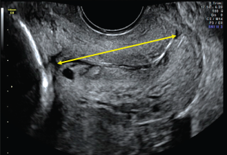 How to measure cervical length