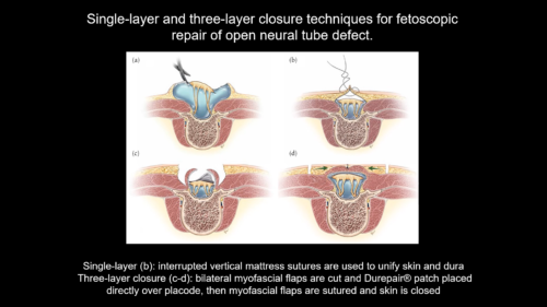 UOG video clip: Comparison of two fetoscopic open neural tube defect ...