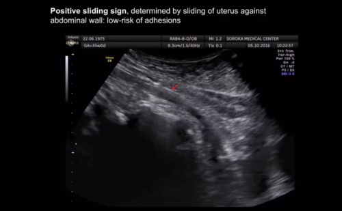 Sliding sign - Tıpacı