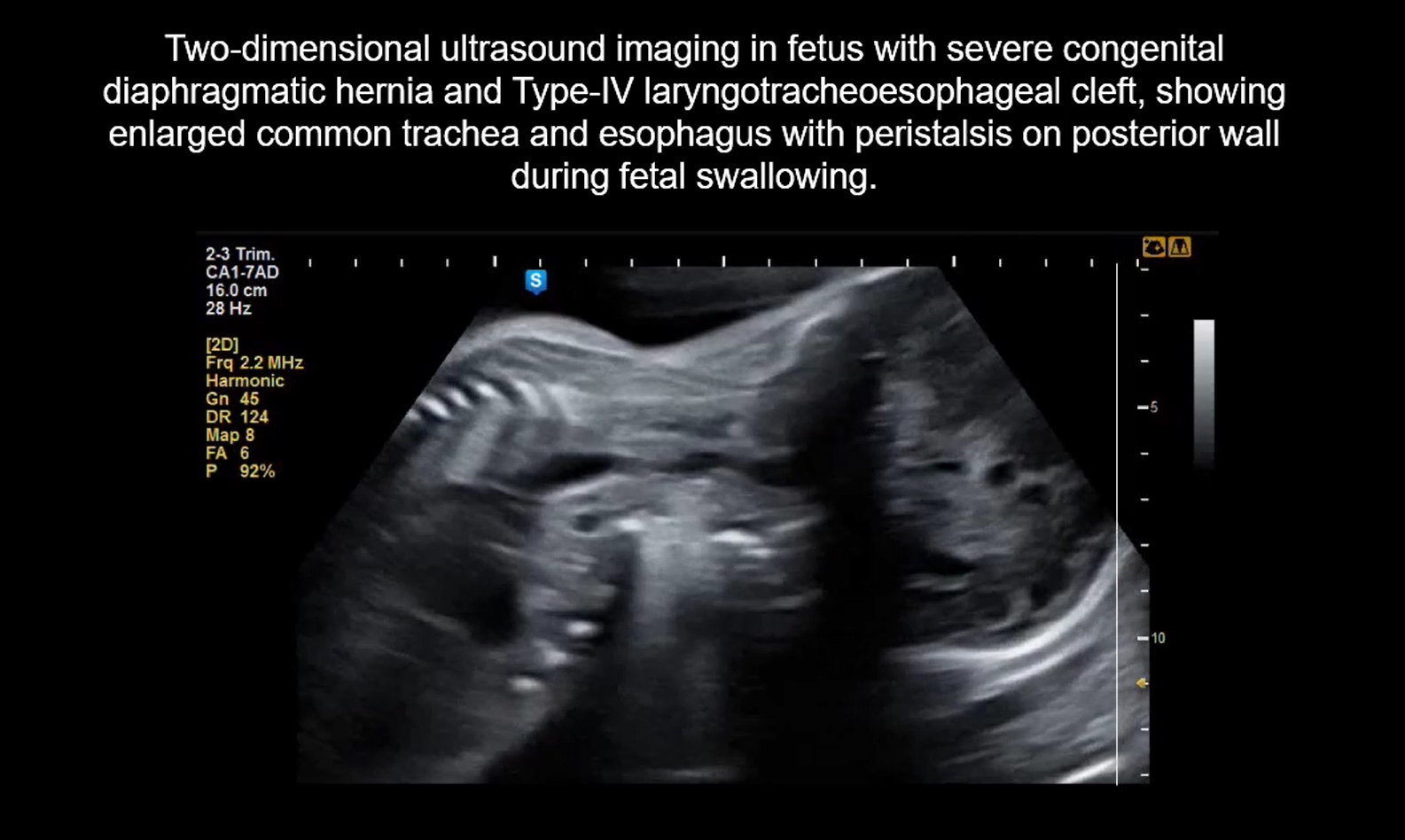 UOG video clip: Type‐IV laryngotracheoesophageal cleft detected during ...