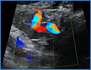 How to record uterine artery Doppler in the first trimester