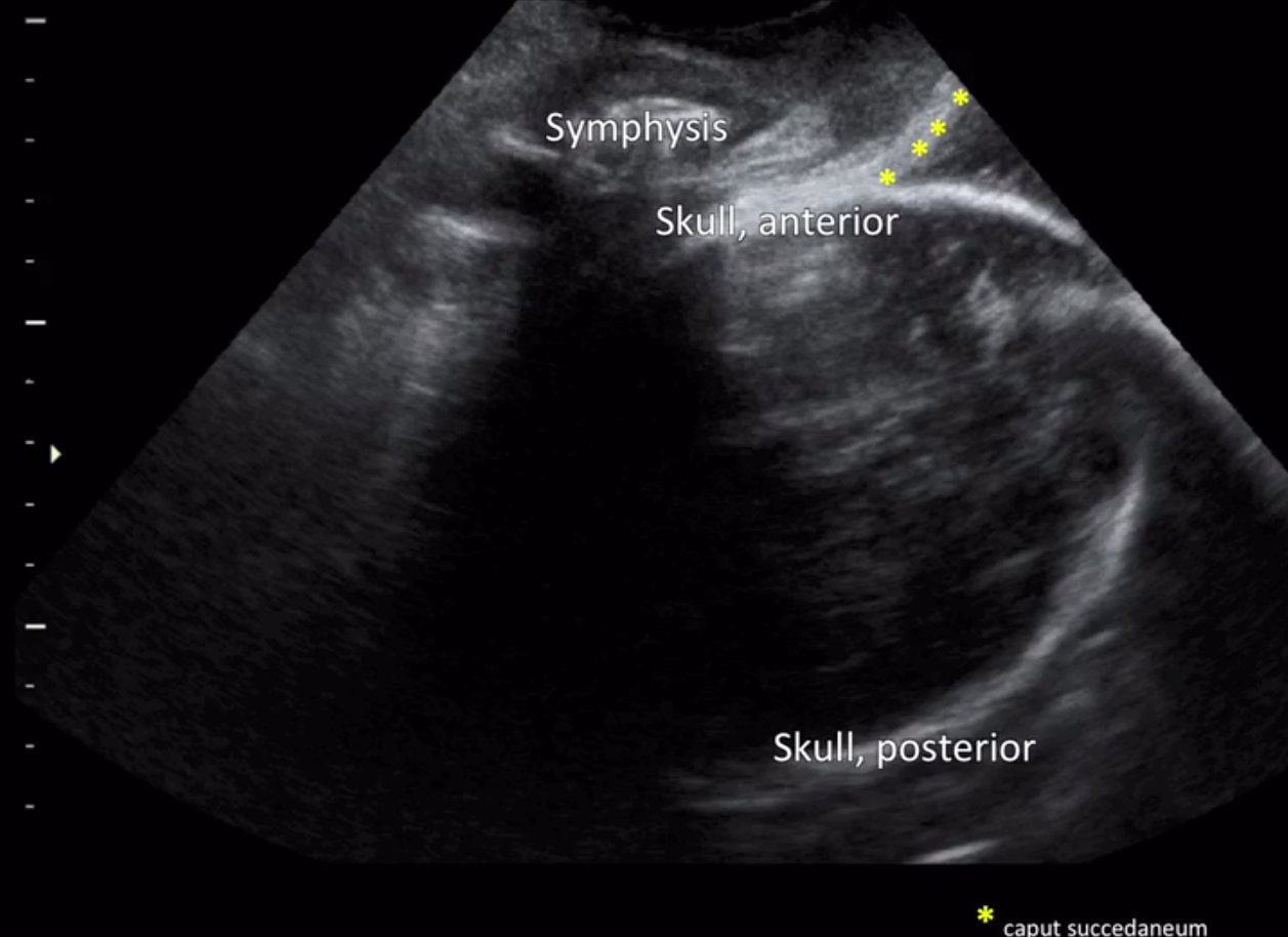 ISUOG Practice Guidelines: intrapartum ultrasound