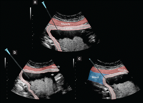 How to perform amniocentesis